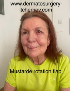 Dermatologic surgery/ dermatosurgery for patient with high risky skin ...